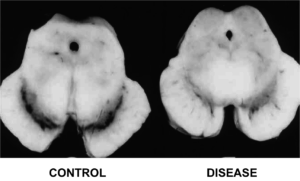 Dopamine and Parkinson's disease - What's the link?